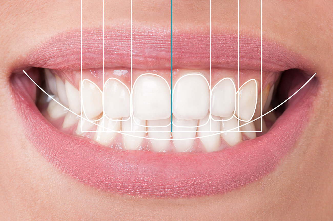 Estetika osmijeha i DSD – digitalni dizajn osmijeha | Centar dentalne ...